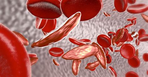 10 Symptoms Of Sickle Cell Anemia Facty Health