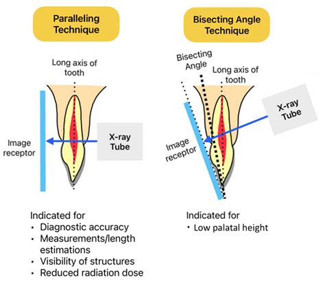 The Performance Of Paralleling Technique And Bisecting Angle Technique