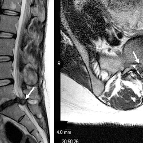 A Sagittal T2 Weighted Magnetic Resonance Imaging Demonstrating A