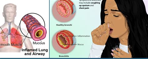 Bronchitis All You Need To Know About It
