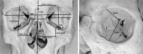 Sof Supraorbital Notch Foramen Iof Infraorbital Foramen Pa Download Scientific Diagram