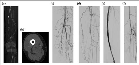 Figure 1 From Current Status Of Distal Embolization In Femoropopliteal