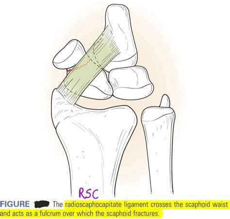 Important Orthopedic Topics Scaphoid Fracture