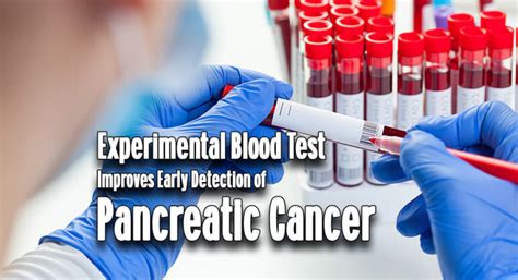 Experimental Blood Test Improves Early Detection Of Pancreatic Cancer Mega Doctor News
