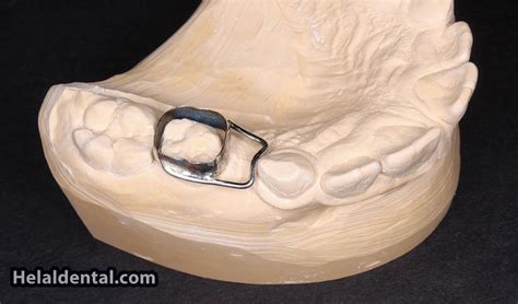 Dental Space Maintainer Helal Dental Company