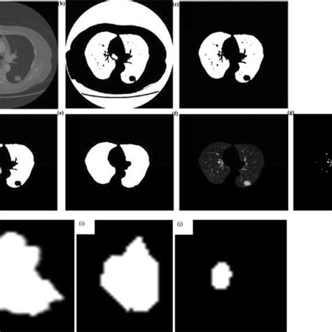Classification And Diagnosis Results Of Preliminary Segmentation A Ct Download Scientific