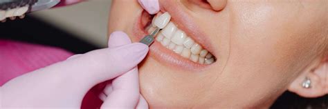 How Composite Veneers Work Coniston Dental
