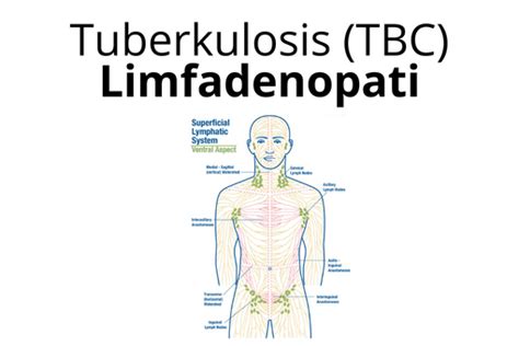Tuberkulosis Tbc Limfadenopati Yayasan Kncv Indonesia