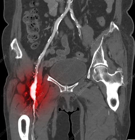 Femoral Aneurysm Ct Scan Stock Image F037 2563 Science Photo Library