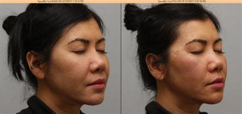 Pdo Threads Before And After Photos Lumier Medical