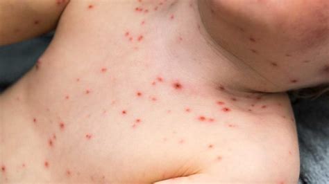 Nampak Serupa Tapi Tak Sama 7 Cara Nak Bezakan Demam Campak Measles