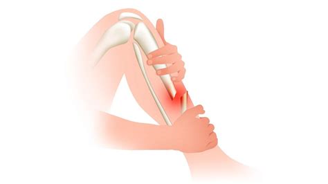 Fracture Types Depuy Synthes