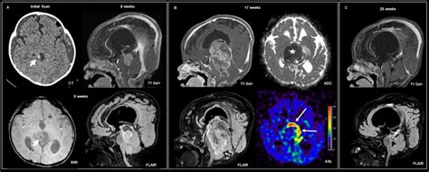 Technology Offers New Insights Into Pediatric Brain Tumors • Healthcare