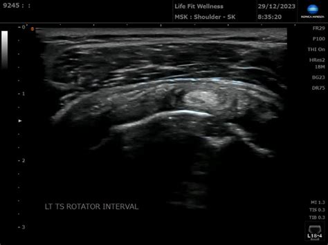 Stewart Kerr On Linkedin Persisting Supraspinatus Tendinopathy With