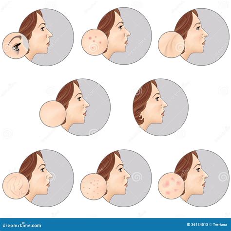 Skin Abscess INFOGRAPHIC HEALTH CARE Royalty Free Stock Photo CartoonDealer Com 158225325