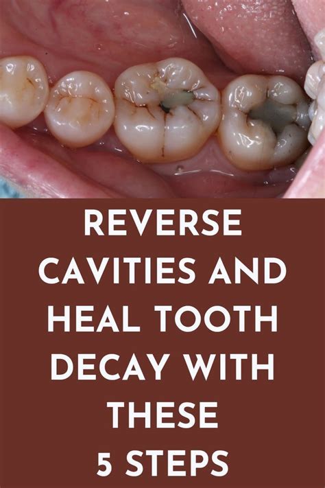 Get Rid Of Cavities And Tooth Decay Kathleen Drews Artofit