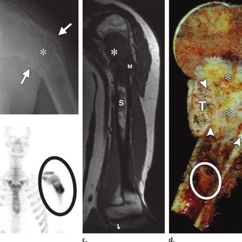 Gross Pathologic And Histologic Appearance Of Ewing Sarcoma Of Bone