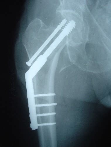 Medical Facts And Mcqs Fractures