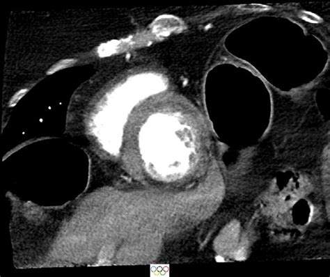 Cardiac Computed Tomography Multiplanar Reformatted Image Showing The Download Scientific