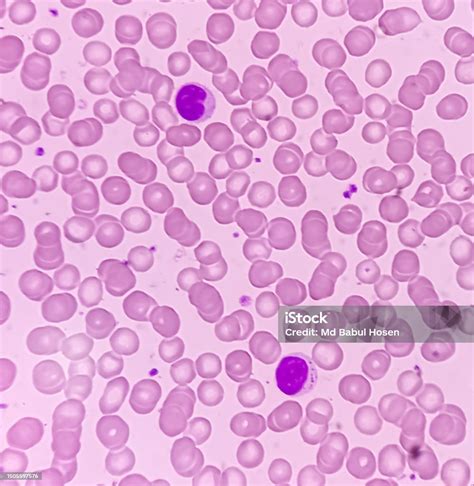 Rbc Wbc 및 혈소판을 보여주는 혈액학적 슬라이드의 현미경 사진 정상 헤모그램 혈구에 대한 스톡 사진 및 기타 이미지 Istock