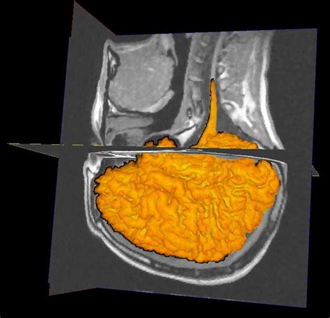 The Result Of Interactively Segmenting An Mri Data Set Of The Brain
