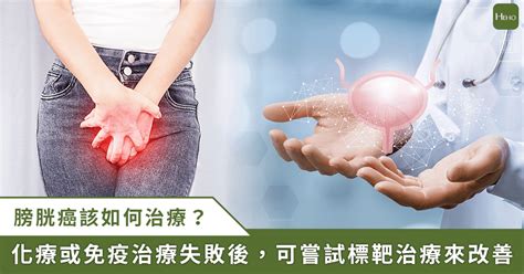 令人提心吊膽膀胱癌復發率高 免疫標靶治療現曙光 Heho Cancer