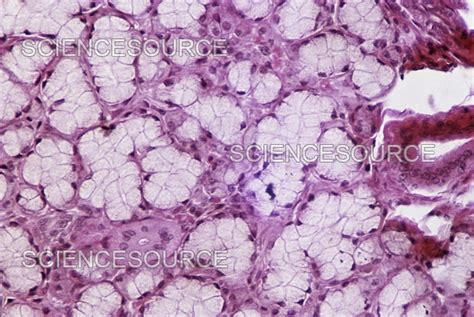 Submandibular Gland Swelling Photograph By Dr P Maraz