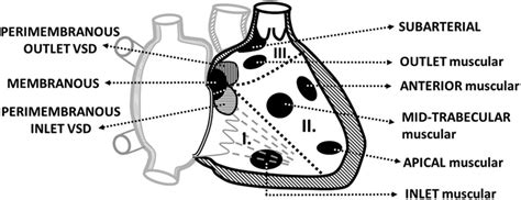 Ventricular Septal Defects Vsds Thoracic Key