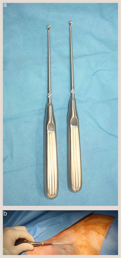 Hyperhidrosis Surgery Oxford International Edition