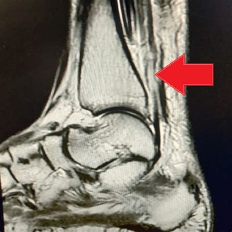 Pre Operative Mri Showing Large Tendon Defect Arrow Download