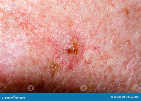 Nevus Or Mole On The Human Body Close Up Skin Cancer Keratosis Or