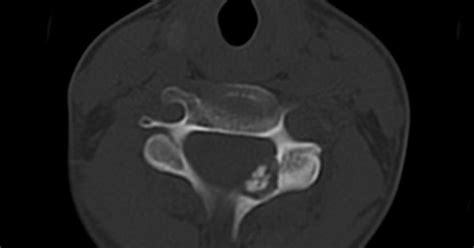 Dr Balaji Anvekar Frcr Spinal Osteoid Osteoma