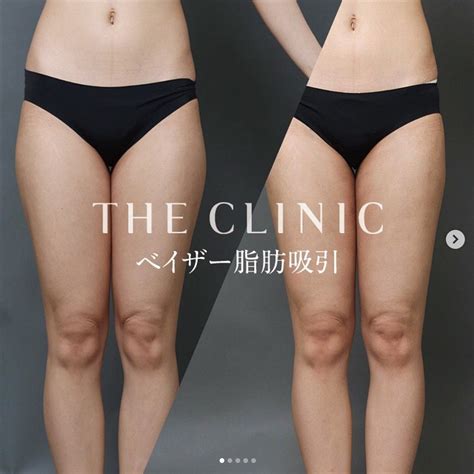 太ももの脂肪吸引 Theclinic Nagoyaのブログ