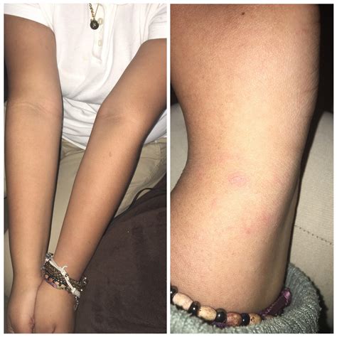 Getting Bruises On My Wrists From Not Bumping Properly Pain Explodes