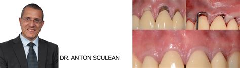 Treatment Of Soft Tissue Defects Around Crown Restored Teeth And Dental Implants Be