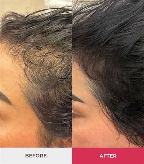 Hair Loss Treatments In Edinburgh Men And Women Treatments