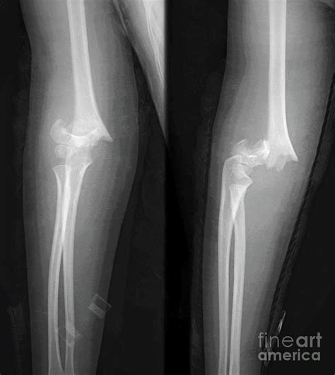 Supracondylar Fracture 2 Photograph By Science Photo Library Pixels