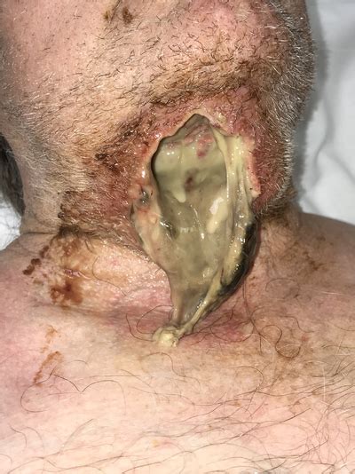 Submandibular Abscess With Orocutaneous Fistula With Visualized Musculature Download