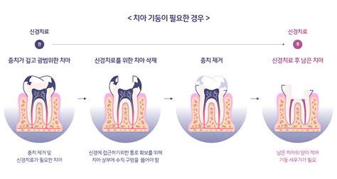 치아 기둥이란 치과 신경치료 후 포스트 크라운 치료 신기행복을심는치과 건강정보