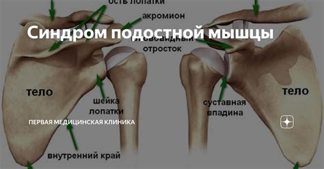Синдром подостной мышцы Первая Медицинская Клиника Дзен