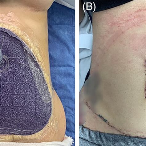 Application Of Cinpt Full‐coverage Dressing Over A Sternal Incision