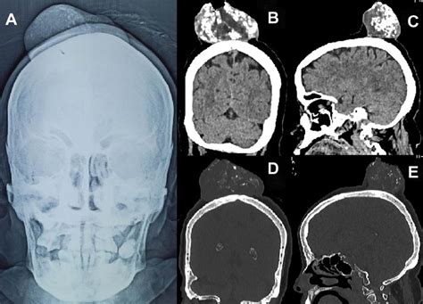 Flecked Calcifications In Scalp Tumors Two Cases Of Giant Ulcerated Trichilemmal Cysts
