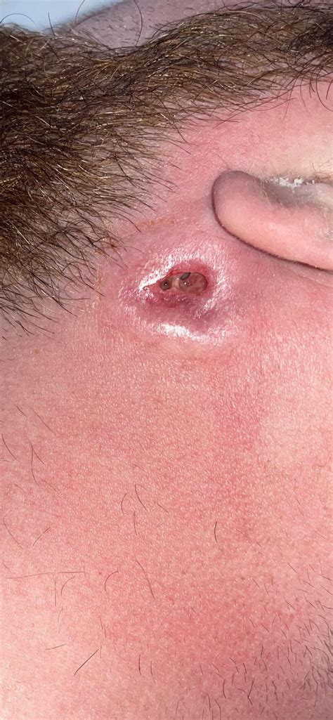 Stages Of Abcess Due To Blocked Salivary Gland Sliced It Open Myself