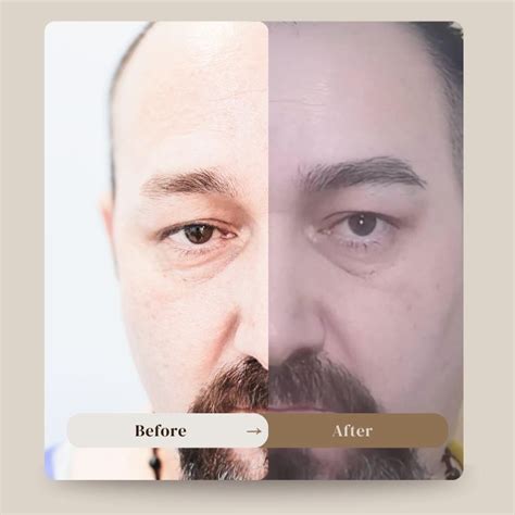 Men Eyebrow Transplant Male Eyebrow Implants Sydney