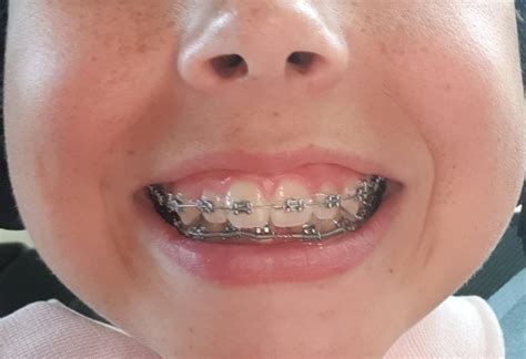 Stage 2 Bottom Teeth Rbraces