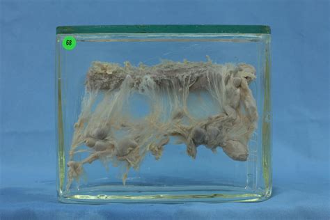 寄生虫病111 68 肠系膜肺吸虫病 病理标本博物馆 复旦大学基础医学院
