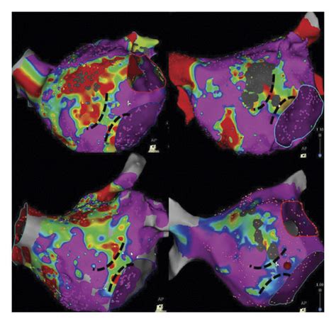 Subsegmentation Of The Low Voltage Area On The Left Atrial Anterior