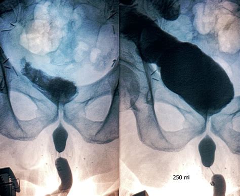 Augmented Bladder Photograph By Zephyrscience Photo Library Fine Art