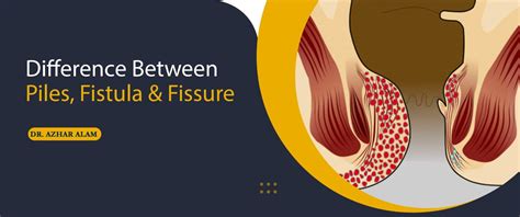 Difference Between Piles Fistula Fissure Dr Azhar Alam