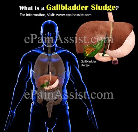 Gallbladder Sludgecausessymptomstreatment